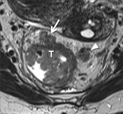 Benign and malignant tumors of the rectum and perirectal region ...