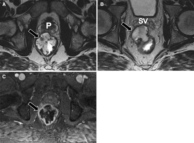 Benign and malignant tumors of the rectum and perirectal region ...