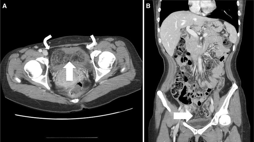 CT findings of acute pelvic inflammatory disease | SpringerLink