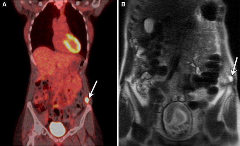 PET/CT and MRI in the imaging assessment of cervical cancer | SpringerLink