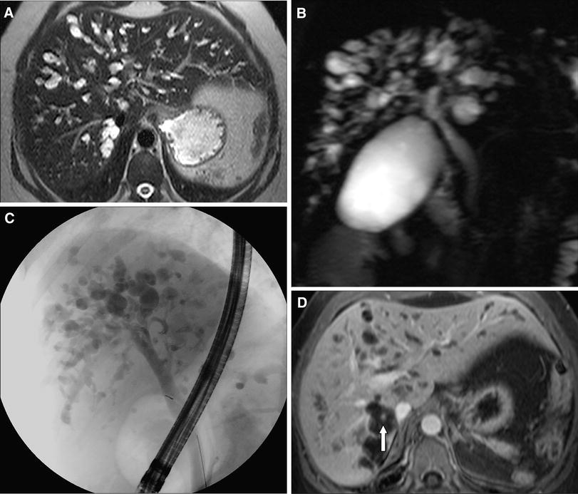 Imaging of choledochal cysts | SpringerLink