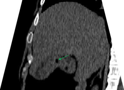 The wall-echo-shadow (WES) sign | SpringerLink