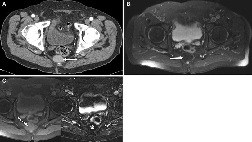 Imaging of tailgut cysts | SpringerLink