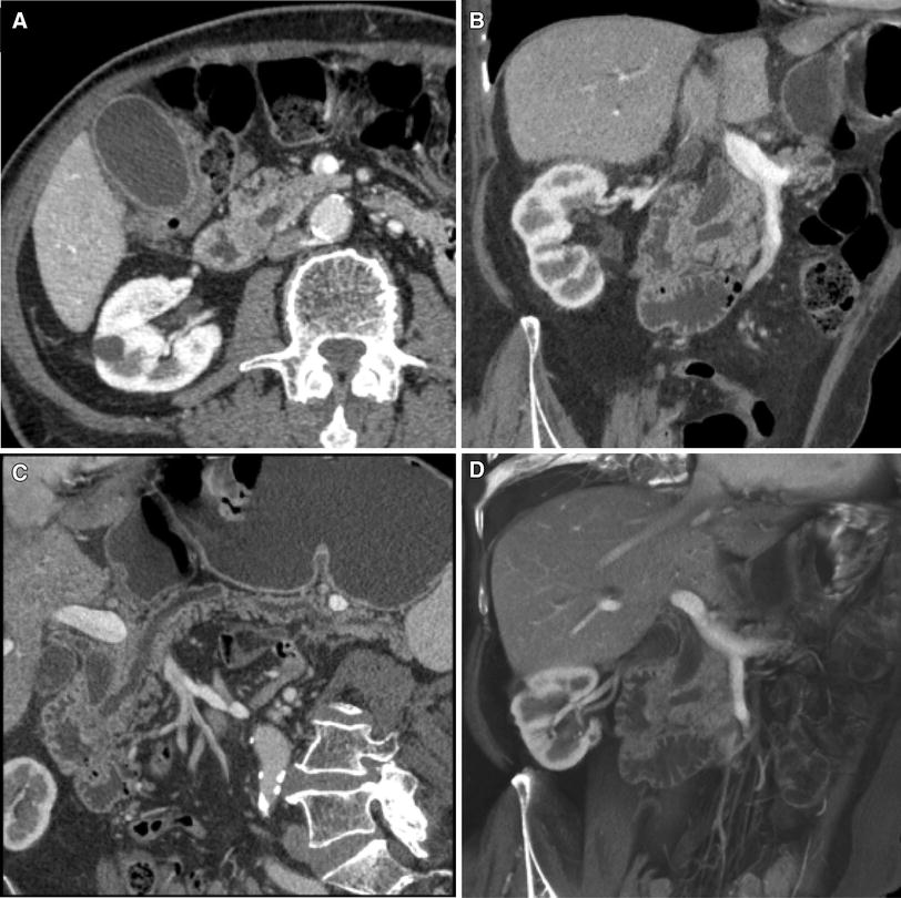 MDCT and MRI of the ampulla of Vater (part I): technique optimization ...