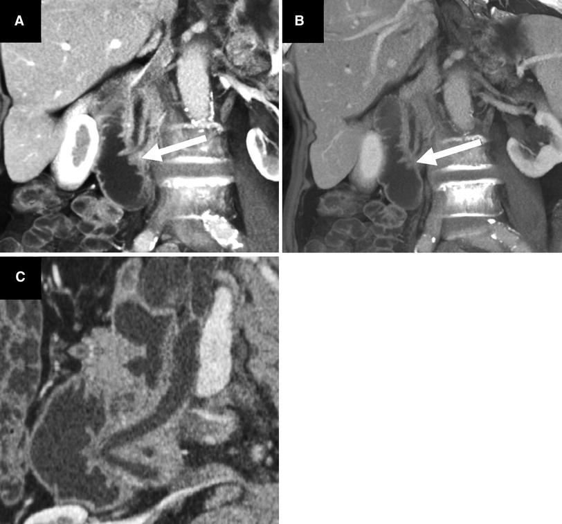 MDCT and MRI of the ampulla of Vater (part I): technique optimization ...
