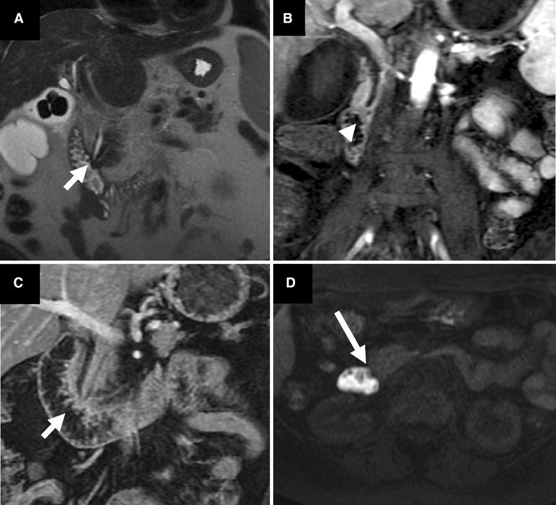 MDCT and MRI of the ampulla of Vater (part I): technique optimization ...