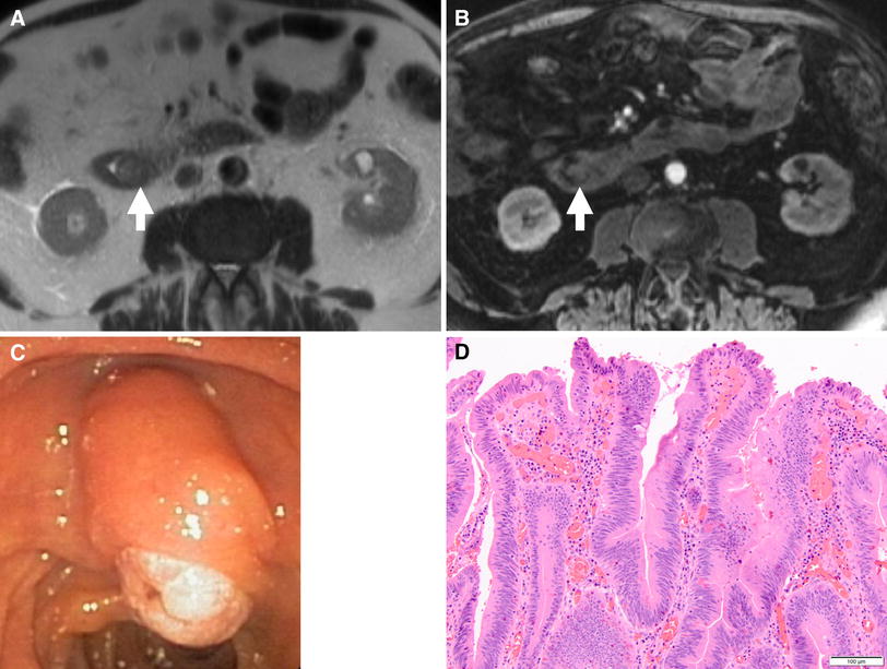 MDCT and MRI of the ampulla of Vater (part I): technique optimization ...