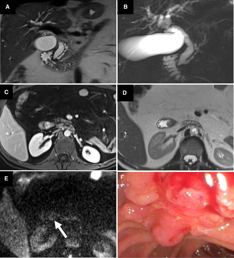 MDCT and MRI of the ampulla of Vater (part I): technique optimization ...