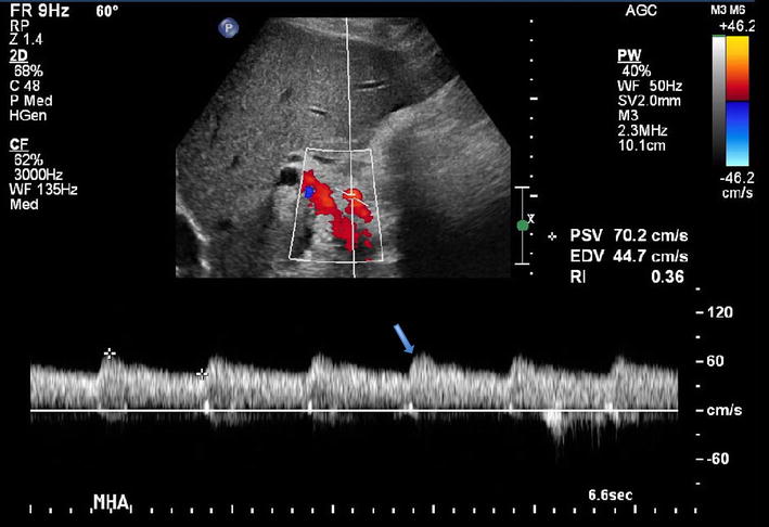 ‘Tardus-Parvus’ waveform | SpringerLink