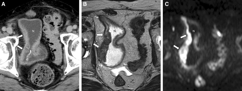 Pictorial review of orthotopic neobladder reconstruction: indication ...