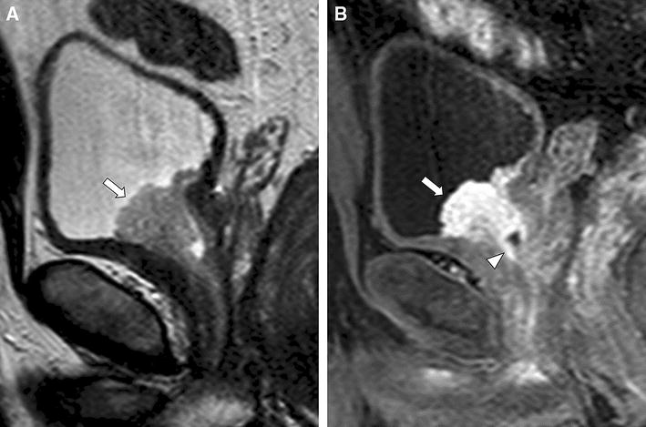 Pictorial review of orthotopic neobladder reconstruction: indication ...