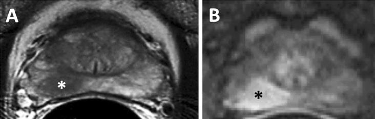 DCE MRI of prostate cancer | SpringerLink
