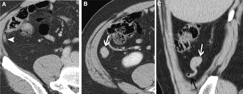 Beyond appendicitis; radiologic review of unusual and rare pathology of ...