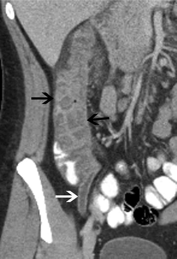 Beyond appendicitis; radiologic review of unusual and rare pathology of ...