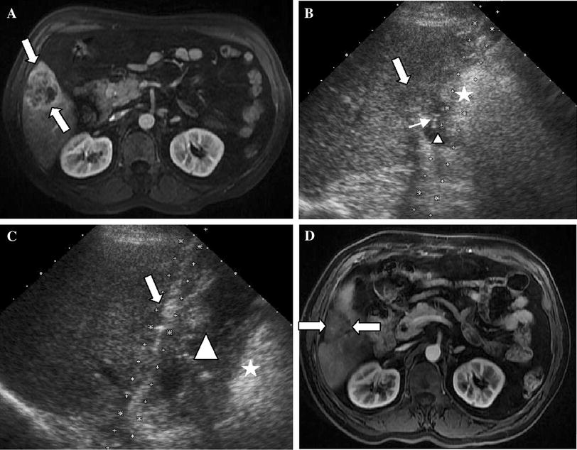 Microwave ablation for liver tumors | SpringerLink