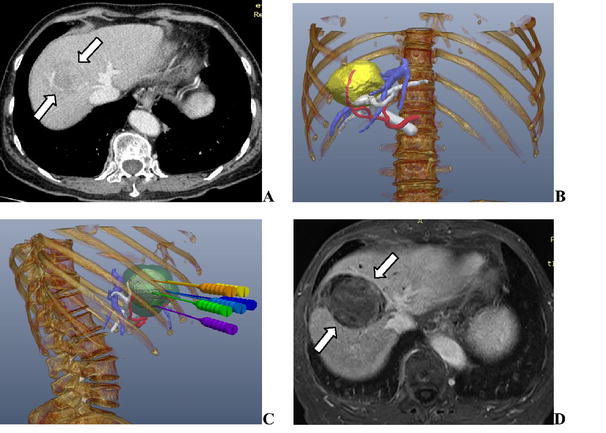 Microwave ablation for liver tumors | SpringerLink
