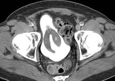 Inflatable penile prosthesis (IPP): diagnosis of complications ...