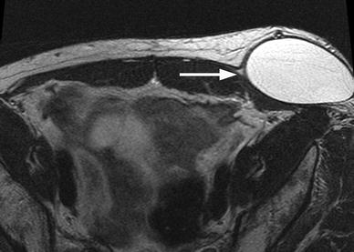 Inflatable penile prosthesis (IPP): diagnosis of complications ...