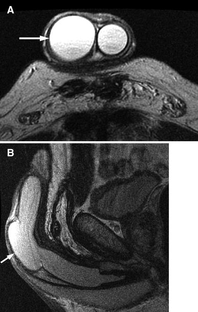 Inflatable penile prosthesis (IPP): diagnosis of complications ...
