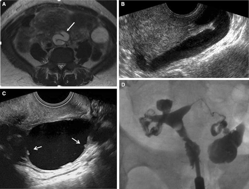 The imaging findings of typical and atypical genital and gynecologic ...