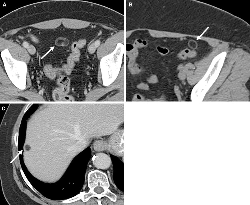 Radiology of epiploic appendages: acute appendagitis, post-infarcted ...