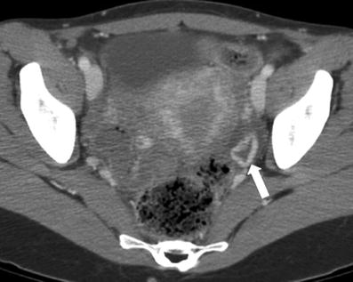 Radiological appearances of corpus luteum cysts and their imaging ...