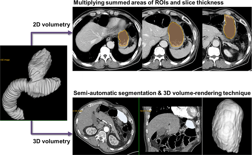 CT gastrography for volumetric measurement of remnant stomach after ...