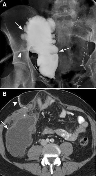 Post-operative colon and urinary diversions: surgical techniques ...