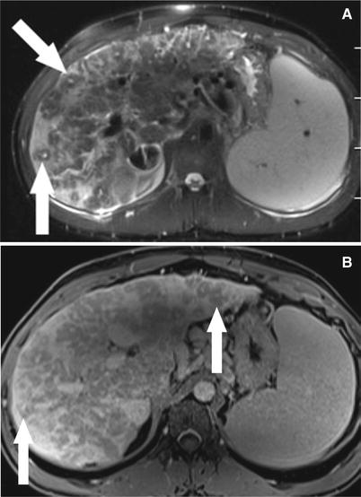 Imaging of autoimmune biliary disease | SpringerLink