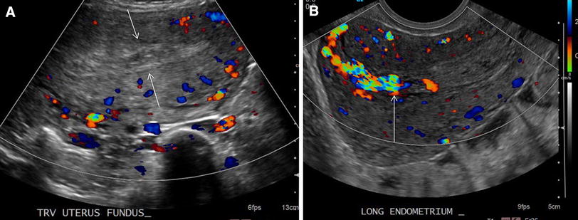 Through thick and thin: a pictorial review of the endometrium ...