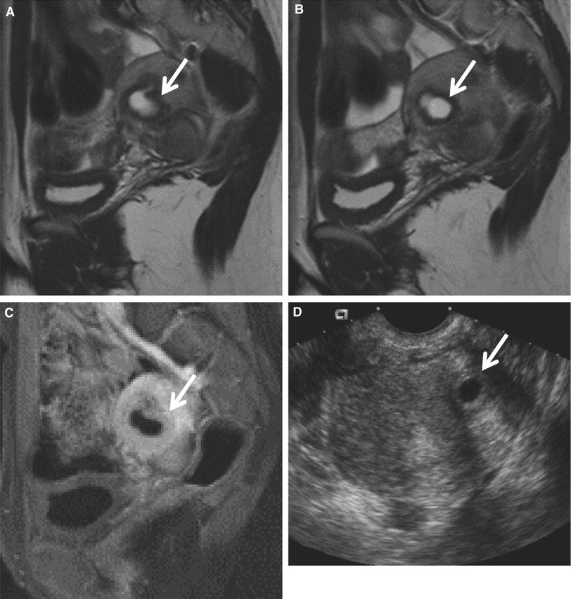 MR imaging of atypical fibroids | SpringerLink