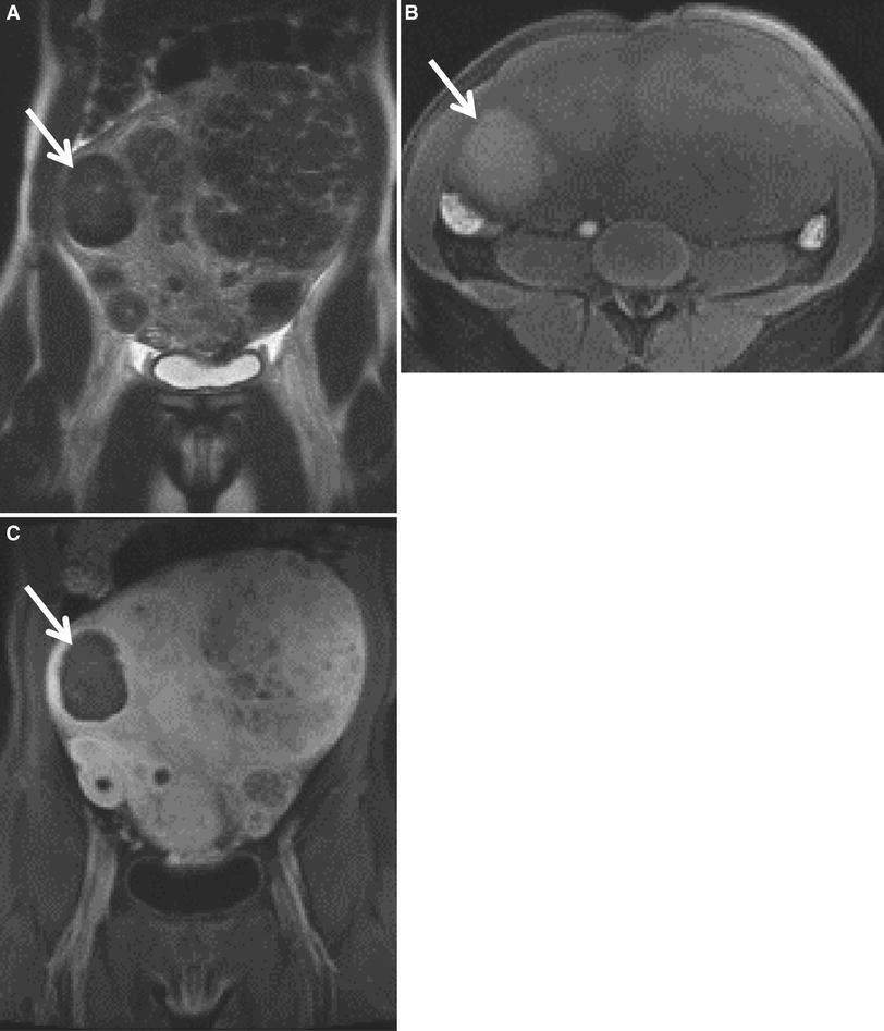 MR imaging of atypical fibroids | SpringerLink