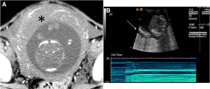 Trauma in pregnant women: assessing detection of post-traumatic ...