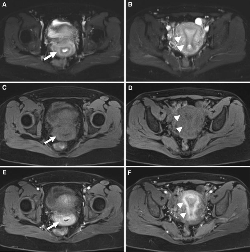 MRI in pelvic inflammatory disease: a pictorial review | SpringerLink