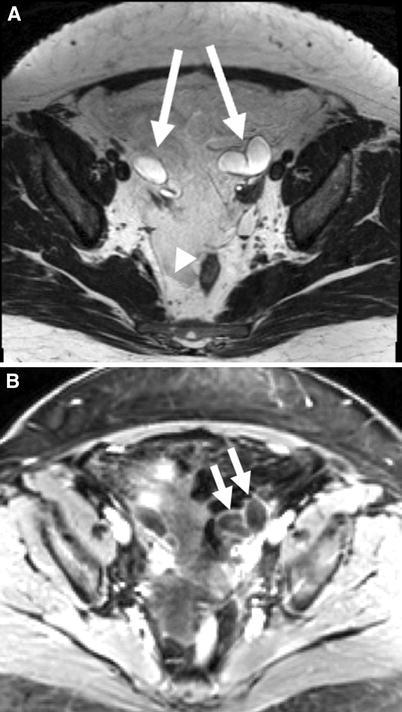 MRI in pelvic inflammatory disease: a pictorial review | SpringerLink