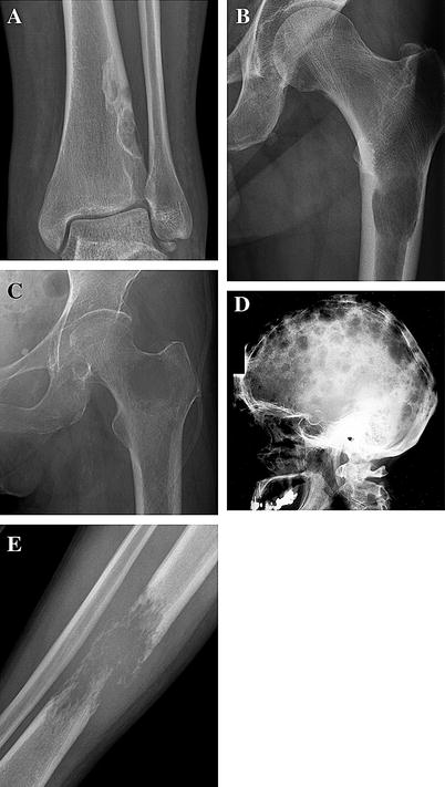 The incidental bone lesion on computed tomography: management tips for ...