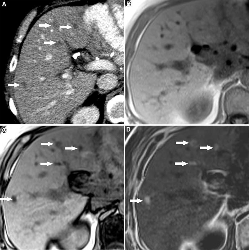 Focal fat deposition in the liver: diagnostic challenges on imaging ...