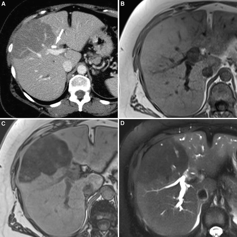 Focal fat deposition in the liver: diagnostic challenges on imaging ...