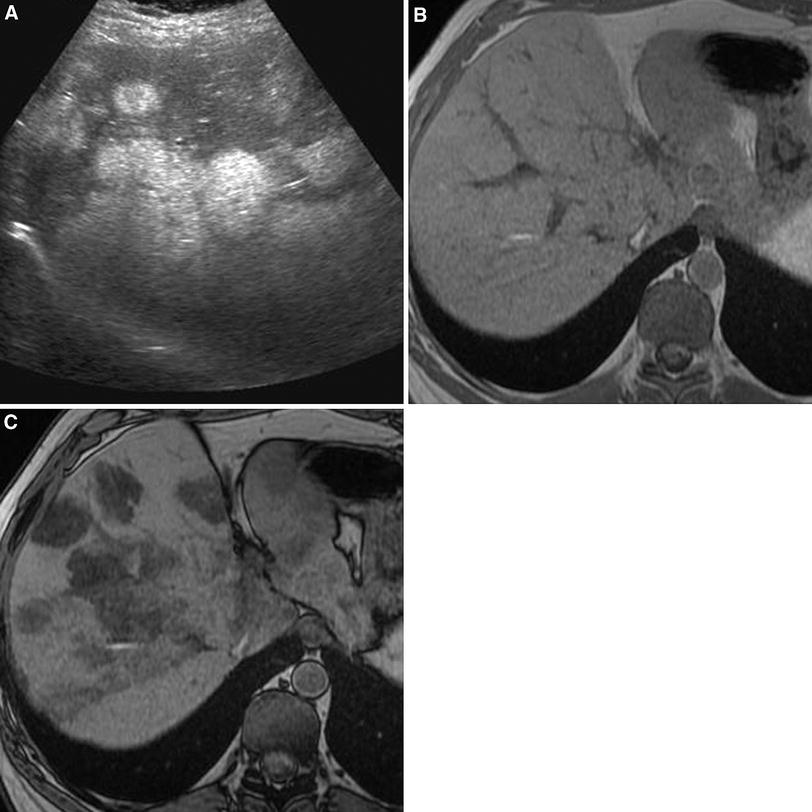 Focal fat deposition in the liver: diagnostic challenges on imaging ...