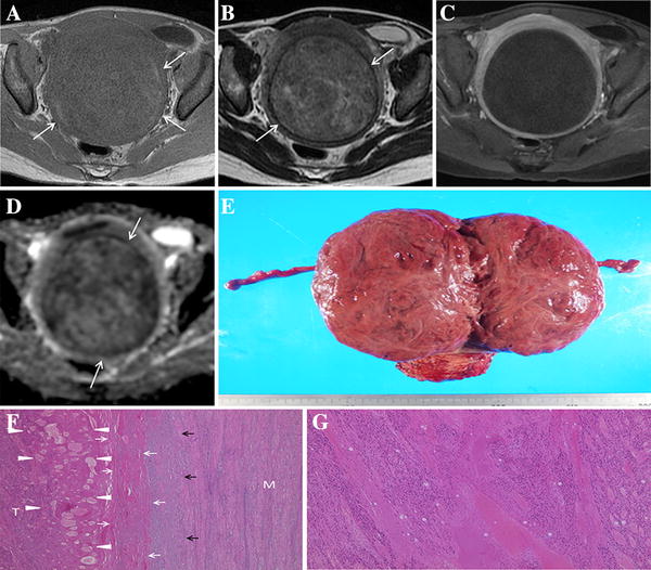 Pathological findings of uterine tumors preoperatively diagnosed as red ...