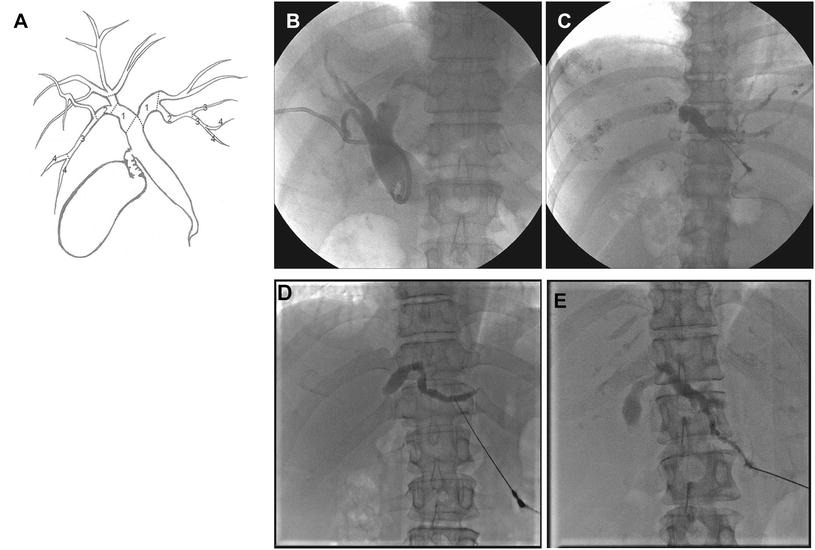 Success and complications of percutaneous transhepatic biliary drainage ...