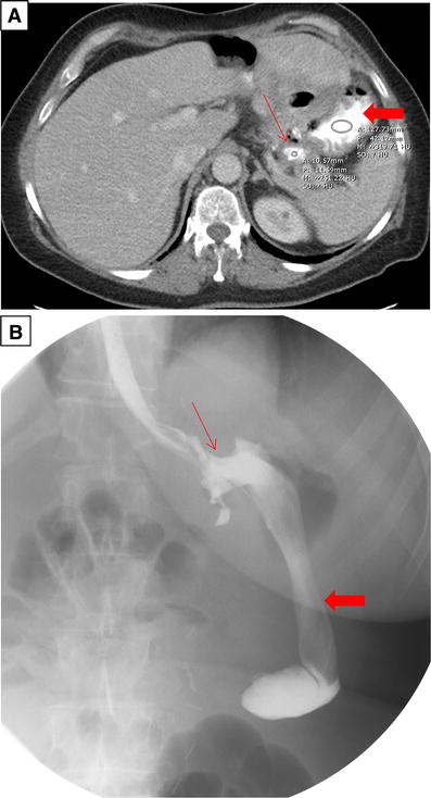 Diagnosis of gastrogastric fistula on computed tomography: a ...