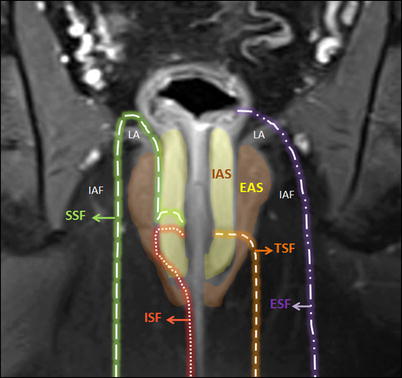 MRI of anal canal: normal anatomy, imaging protocol, and perianal ...