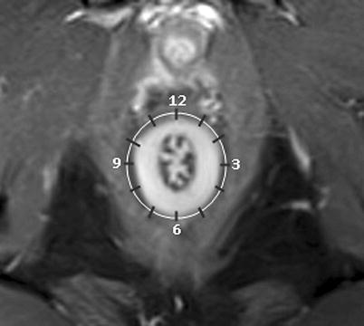 MRI of anal canal: normal anatomy, imaging protocol, and perianal ...