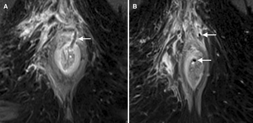 MRI of anal canal: normal anatomy, imaging protocol, and perianal ...