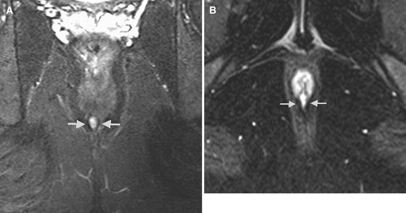 MRI of anal canal: normal anatomy, imaging protocol, and perianal ...