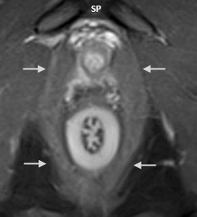 MRI of anal canal: normal anatomy, imaging protocol, and perianal ...