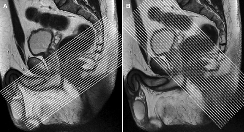 MRI of anal canal: normal anatomy, imaging protocol, and perianal ...