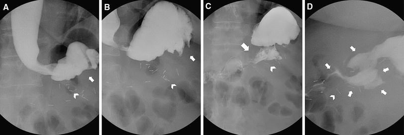 What the radiologist needs to know about gastrointestinal endoscopic ...