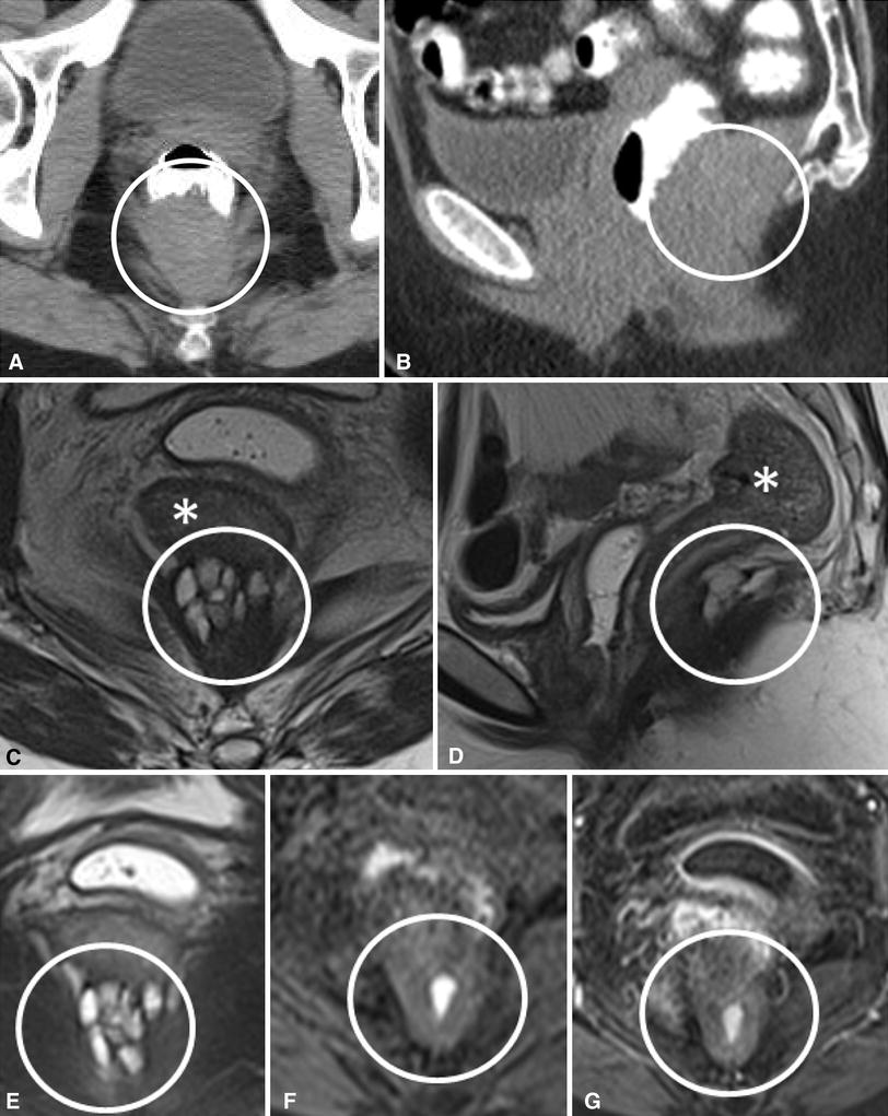 The bottom line: MRI and CT findings of unusual rectal and perirectal ...